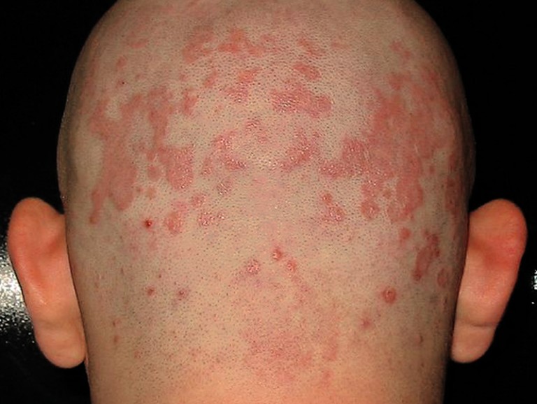 Seborrhoeic-Dermatitis | Atopic Laboratories Pvt.Ltd.